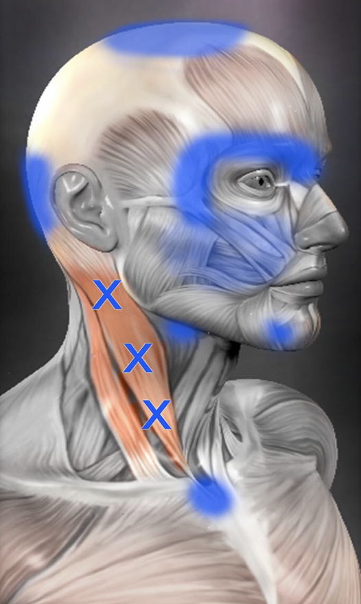 The Sternocleidomastoid Muscle - Massage Aha!